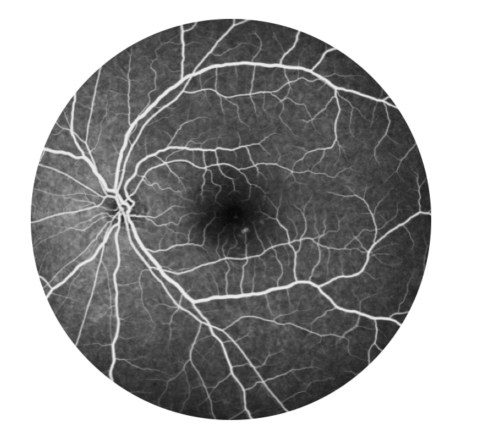 Fundus Fluorescein Angiography Fundus Angiography Eye Synergy Eye Care